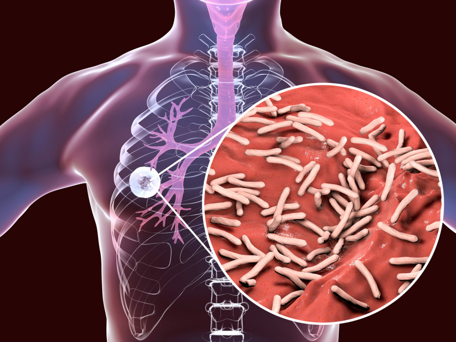 ¿Cómo afecta la tuberculosis a nuestra salud? - Clínica Andes Salud El Loa